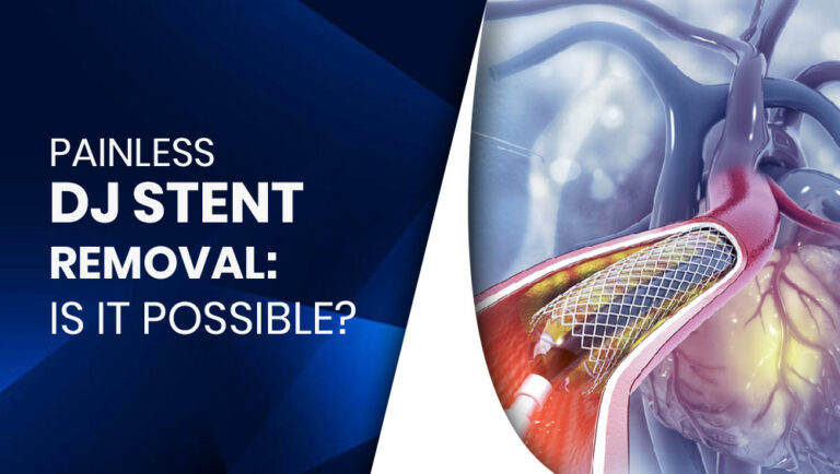 Painless DJ Stent Removal: Is It Possible? - The CureStone
