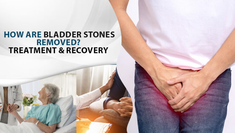 How Are Bladder Stones Removed? Treatment & Recovery - The CureStone