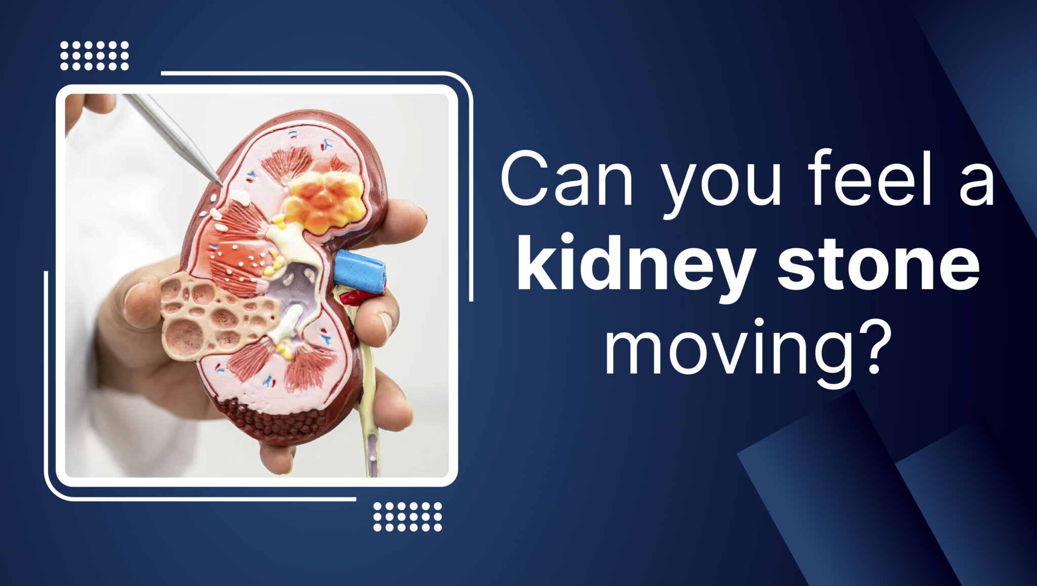 Can you feel a kidney stone moving? - The CureStone